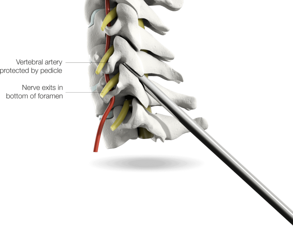 Posterior Cervical Fusion with DTRAX Spinal System | Providence