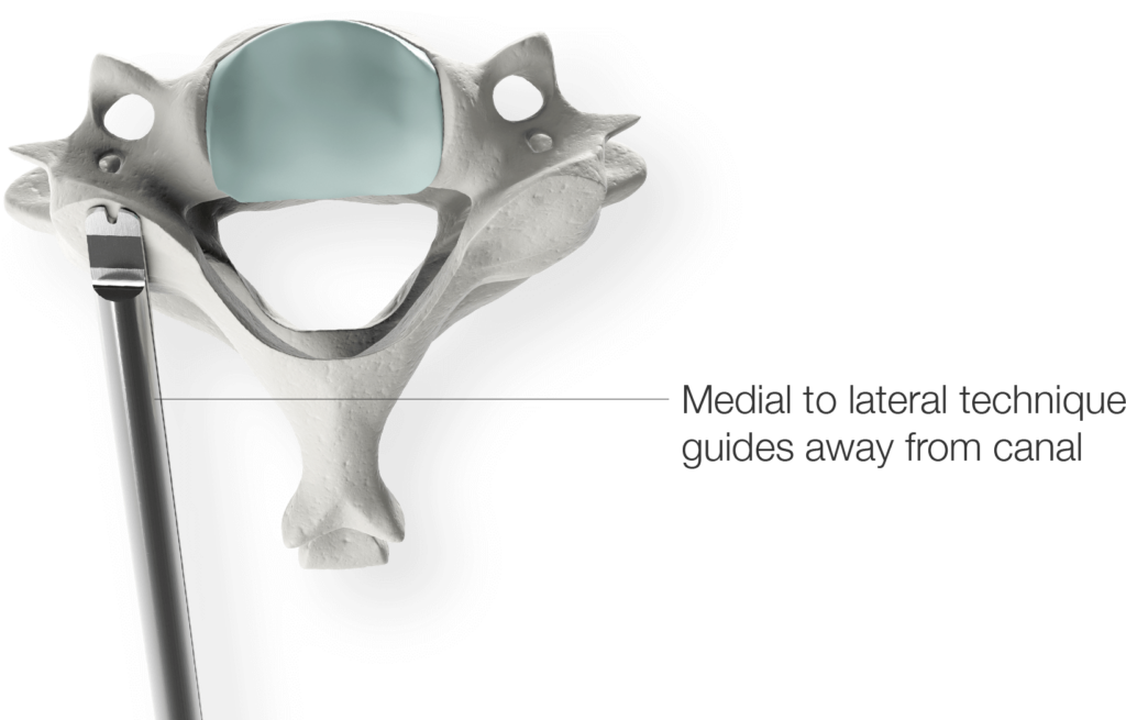 Posterior Cervical Fusion with DTRAX Spinal System | Providence