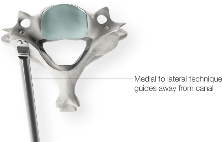 Posterior Cervical Fusion with DTRAX Spinal System | Providence