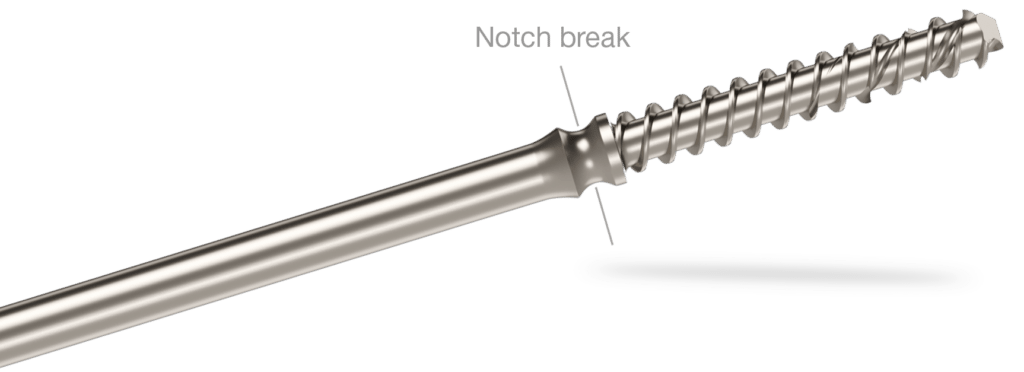 ALLY Screw System | Providence