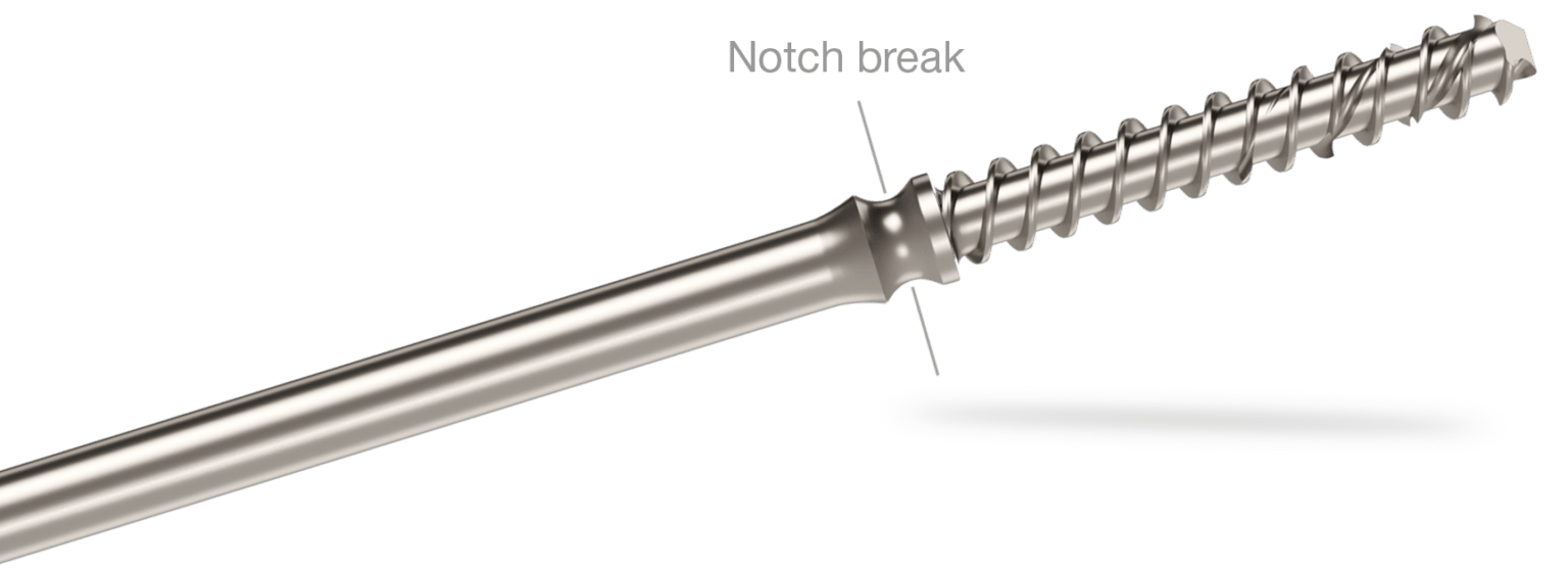 ALLY Screw System | Providence