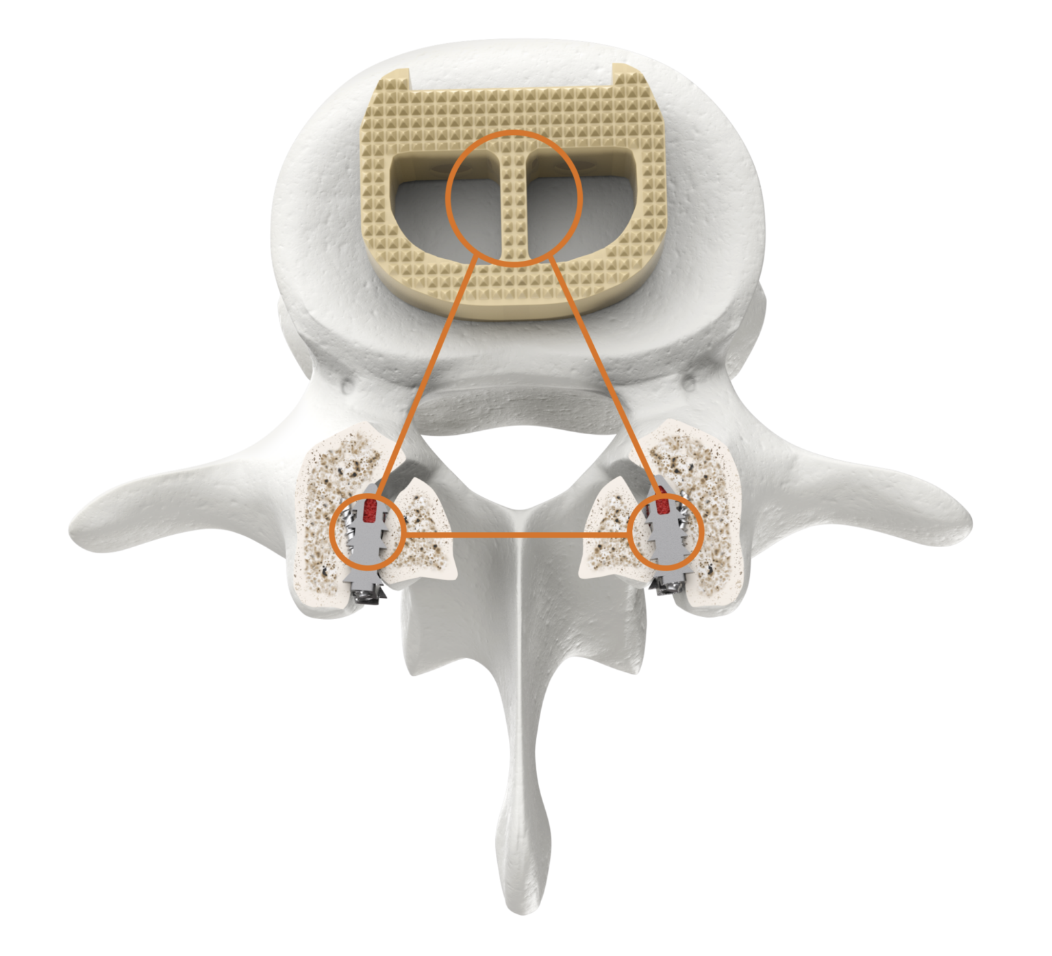Spinal Devices for Posterior Cervical & Lumbar Fusion | Providence